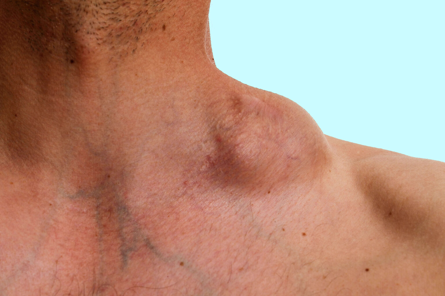 Lymphoma Stages: What to Anticipate - Apollo Proton