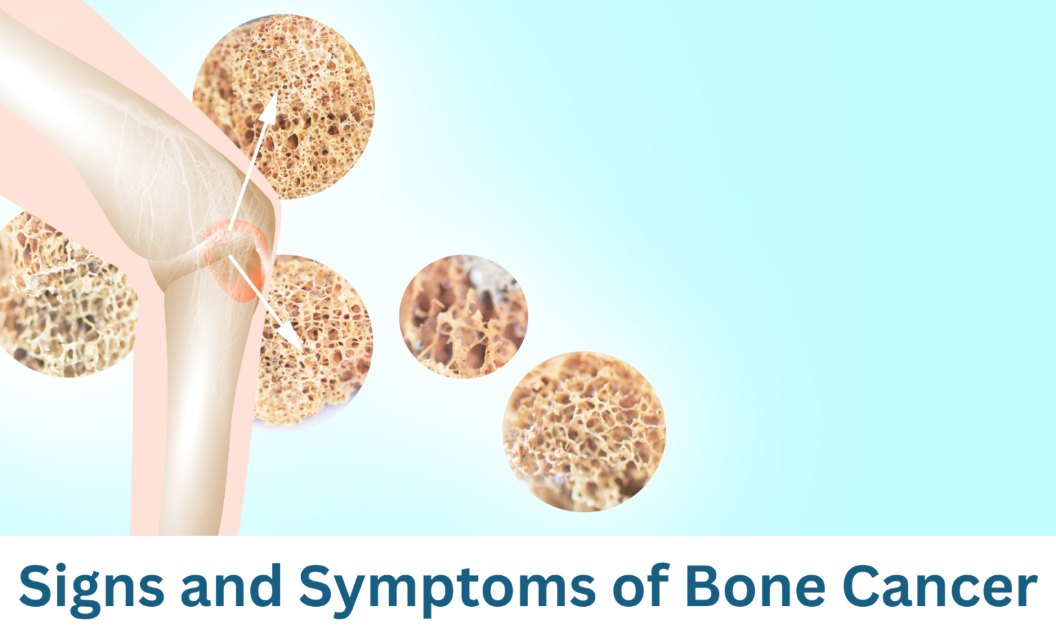 Signs and Symptoms of Bone Cancer - Proton Therapy