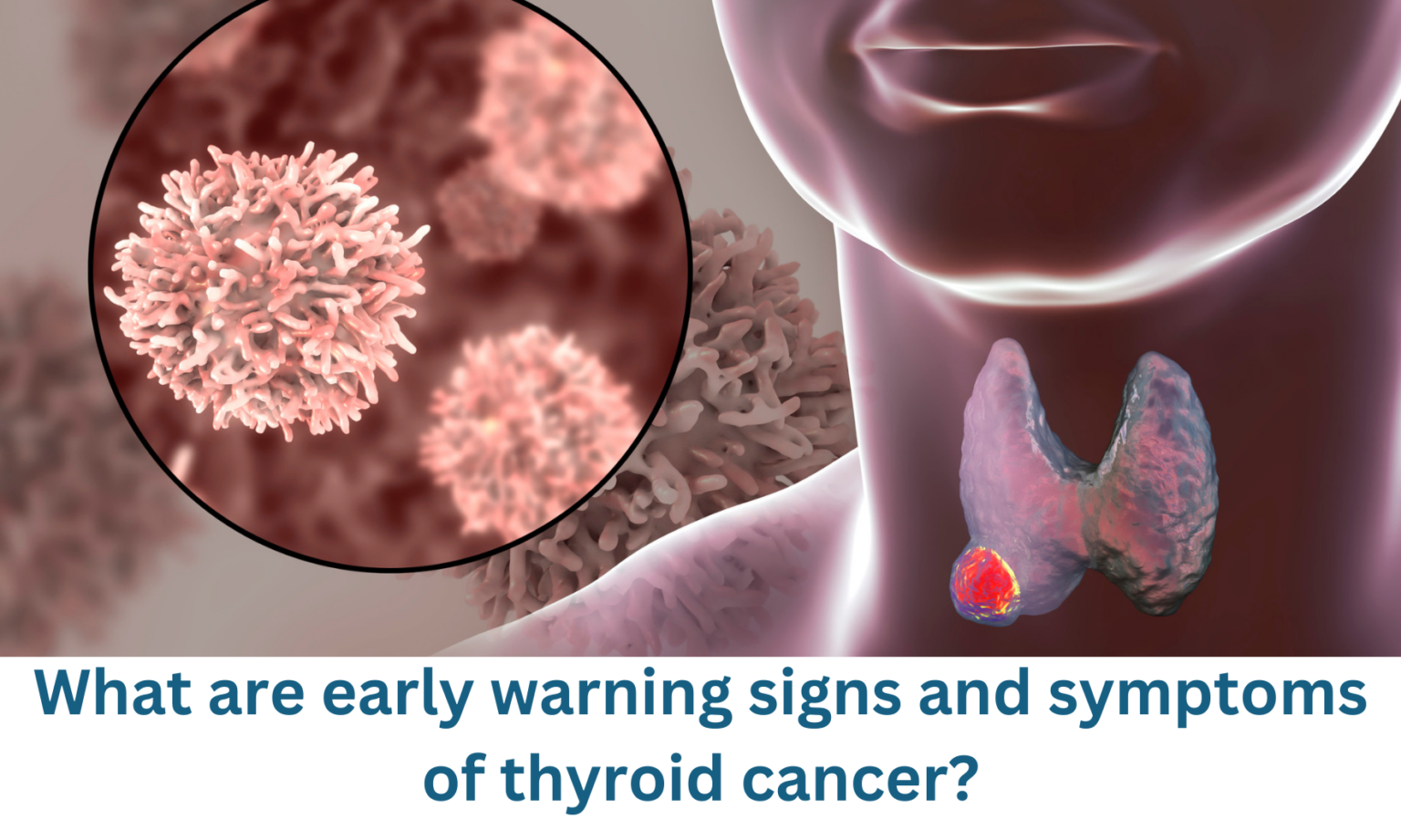 Kanker Tiroid: Tanda & Gejala Awal | Terapi Proton