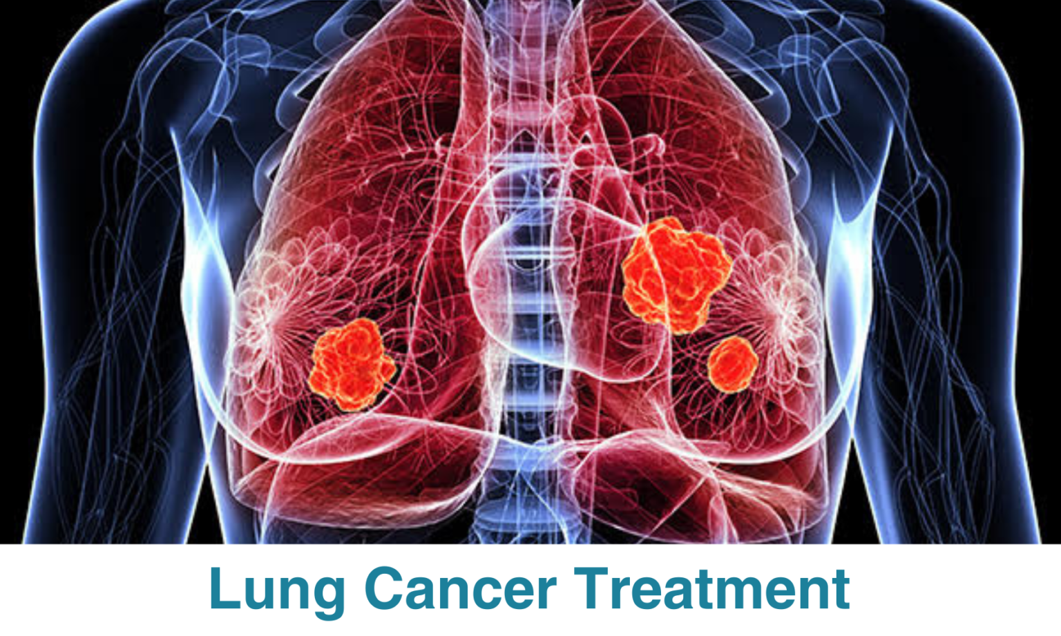 Lung Cancer Treatment - Proton Therapy Lung Cancer Treatment - Proton Therapy