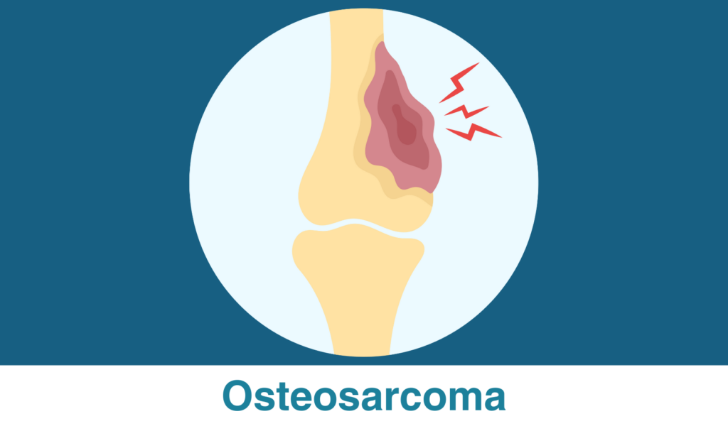 What is Osteosarcoma? - Proton Therapy