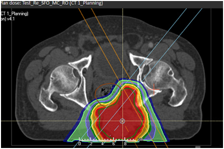 Bone Sarcomas - Proton Therapy