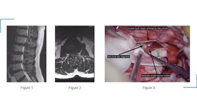 70-Year-Old Male Operated for a Rare Pathology – Intra-Dural Disc ...