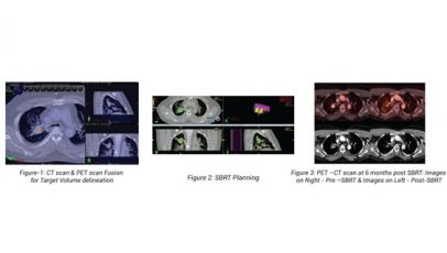 Stereotactic Body Radiation Therapy ( SBRT ) for Lung Cancer – A ...