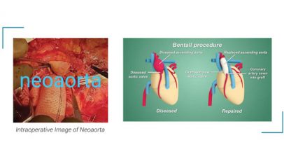 REDO (Post Mitral Valve Replacement ) Bentall’s surgery for Aortic Root ...