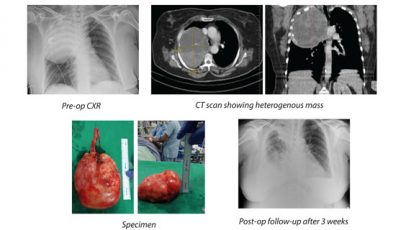 HEMI-CLAMSHELL Approach for Large Complex Intrathoracic Tumors - Apollo ...