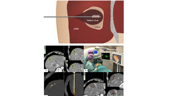 Liver Cancer Treated with Microwave Ablation of The Tumor - Apollo ...