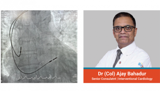 Novel & Superior Pacemaker Implant Technique Conduction System Pacing ...