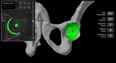 Robotic Hip Replacement Surgery - Apollo Hospitals