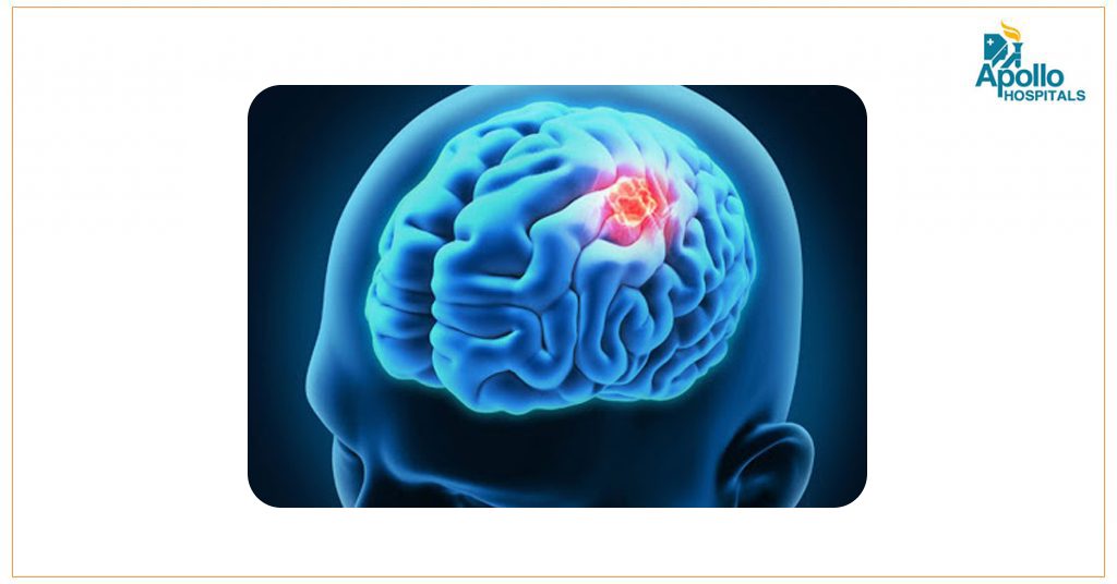 How Can A Pathologist Differentiate Between a Benign Tumour and a ...