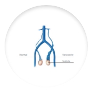 Small Incisions, Big Impact: Advanced Varicocelectomy Procedures