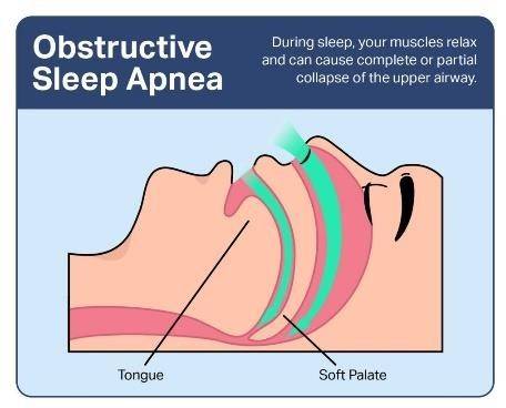 Snoring and sleep apnea explained - Apollomedics Super Speciality Hospitals