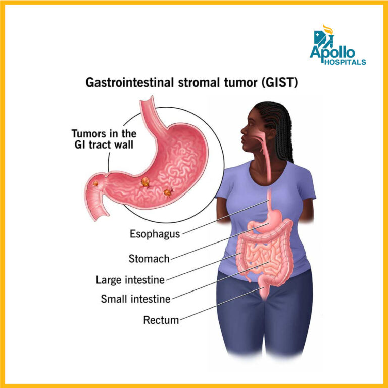 Naon Tumor Stromal Gastrointestinal Langka (GISTs) sareng Kumaha ...