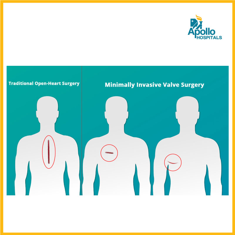Minimally Invasive Cardiac Surgery (MICS): A Revolution in Heart Care ...